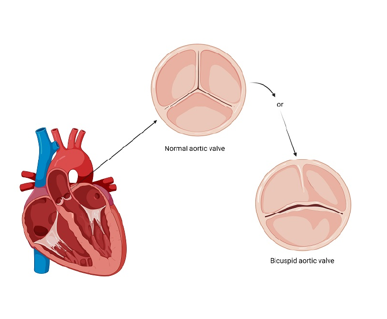 Bicuspid Aortic Valve - Dr. Ramji Mehrotra